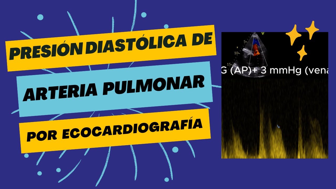 Presión Diastólica de Arteria Pulmonar [PDAP] por ECOCARDIOGRAFÍA - YouTube