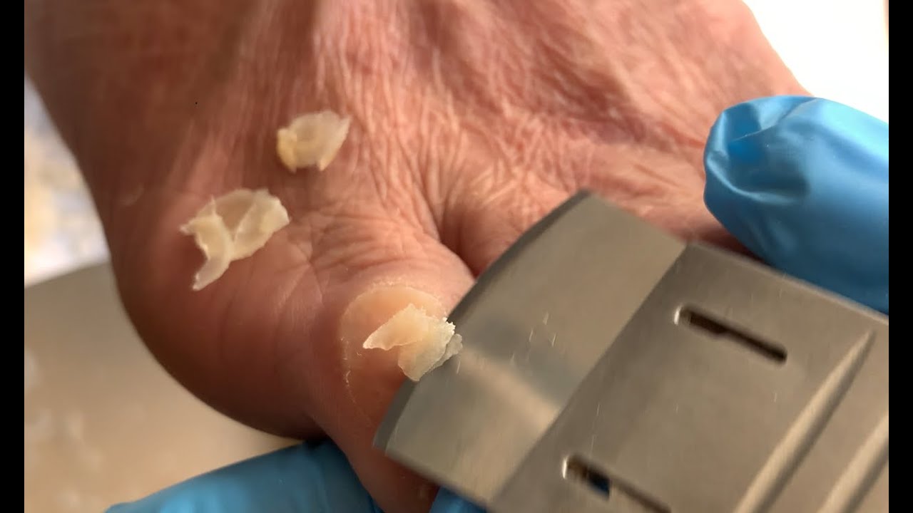 calluses on the little toes, prolonged friction【Xiao Yan Pedicure ...