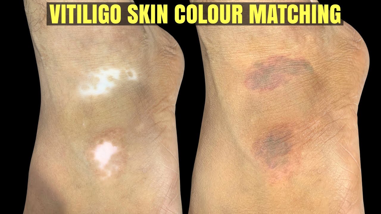 Vitiligo disease treatment | skin colour matching permanent solution by ...