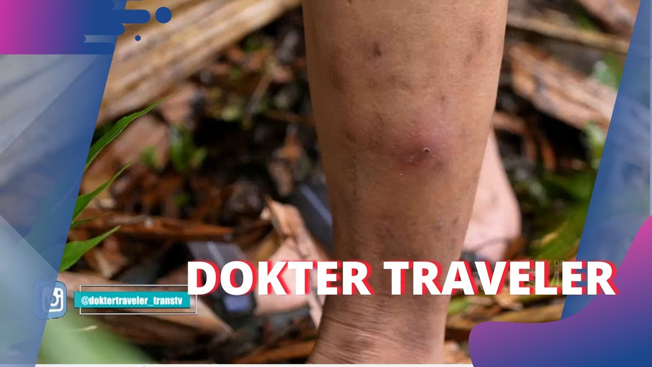 Pyoderma, Penyakit Yang Kerap Menyerang Kulit | DOKTER TRAVELER (21/1 ...