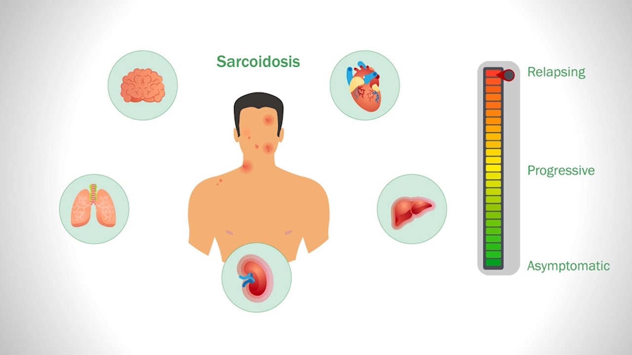 Annals Animated: Clinical Practice Guideline for the Diagnosis and ...