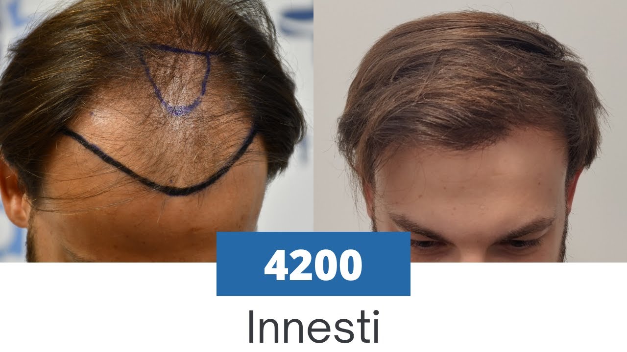 12 mesi dopo il mio trapianto di capelli | Elithair - YouTube