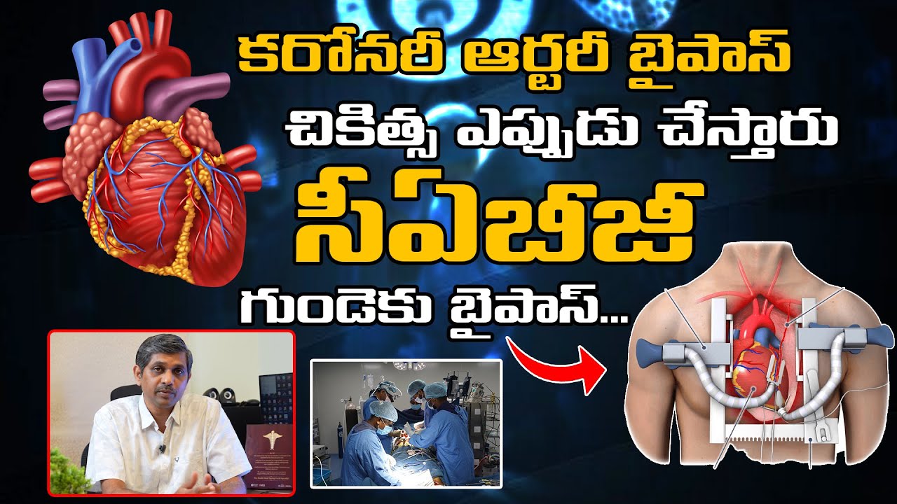 #HEART BYPASS SURGERY ( CABG) | HOW IS CORONARY ARTERY BYPASS GRAFT ...