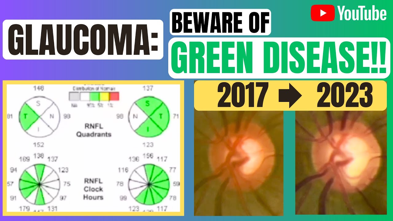Beware of GREEN Disease in Glaucoma! [Clinic PowerUp] - YouTube