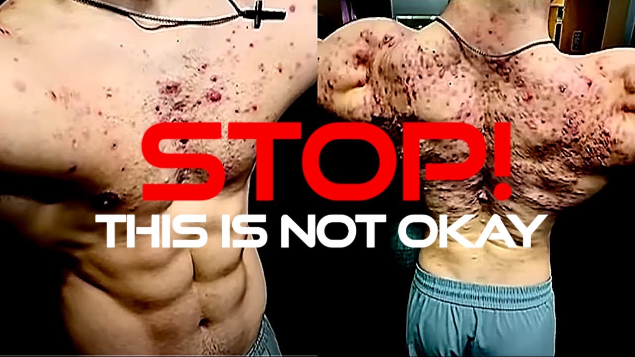 Worst Steroid Acne You’ll Ever See - YouTube