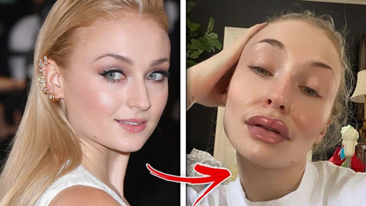 Unrecognizable Celebrities Who Had TOO Much Plastic Surgery - Part 2 ...