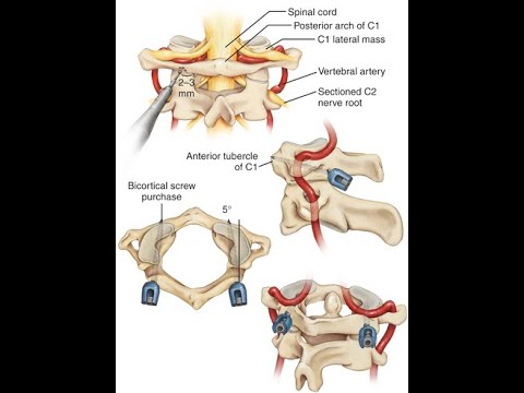 FMD WITH POSTERIOR C1 C2 FIXATION - YouTube