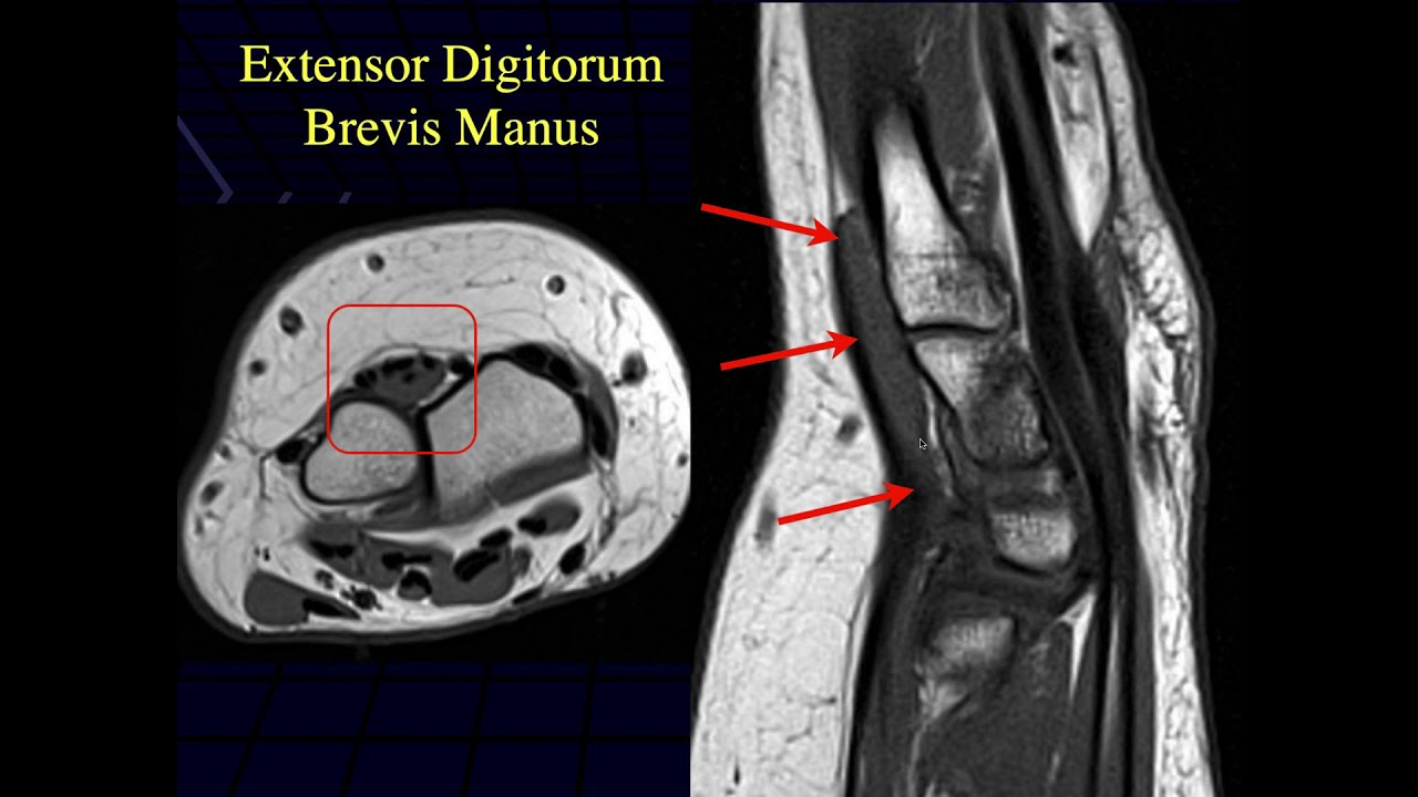 Extensor Digitorum Brevis Mri