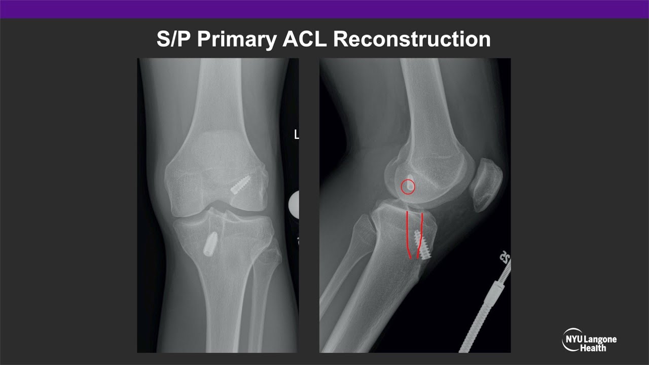 Revision ACL Reconstruction and Modified Lemaire ALL Reconstruction for ...