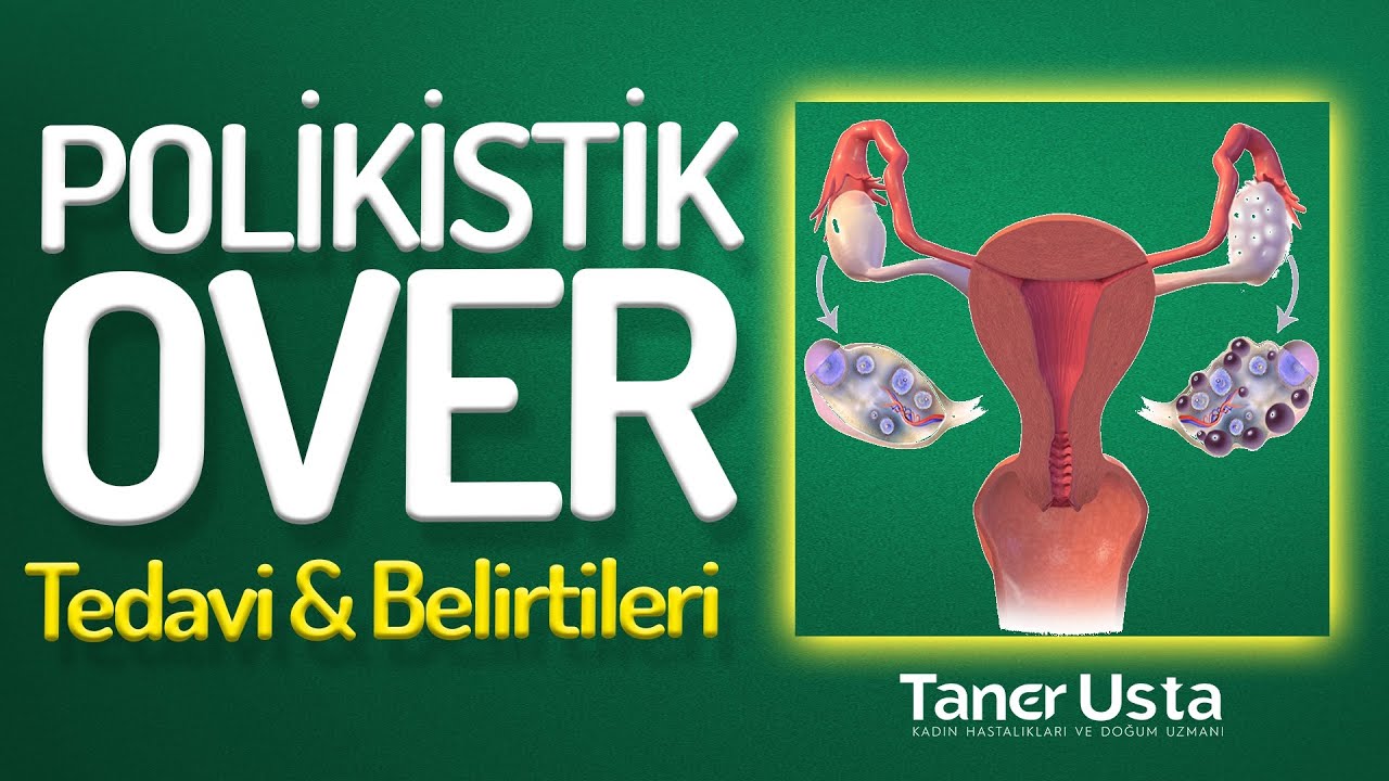 Polikistik Over Tedavisi ve Belirtileri - Prof. Dr. Taner Usta - YouTube