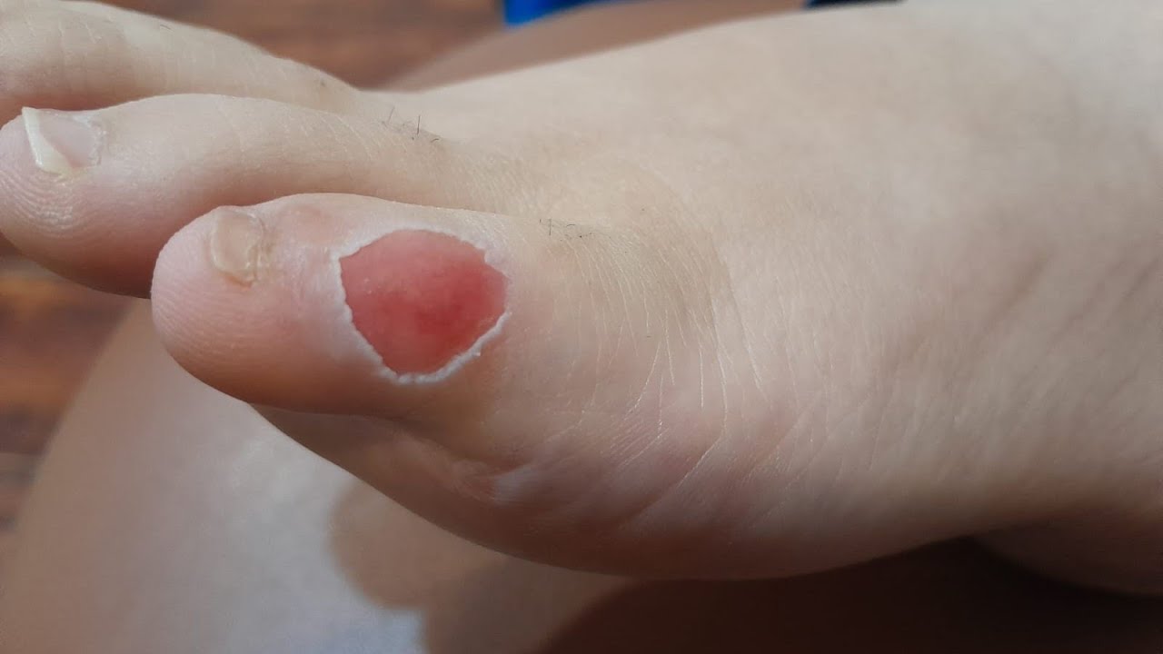 Foot infection treatment#pimple #foot #footcare #satisfying #nails # ...