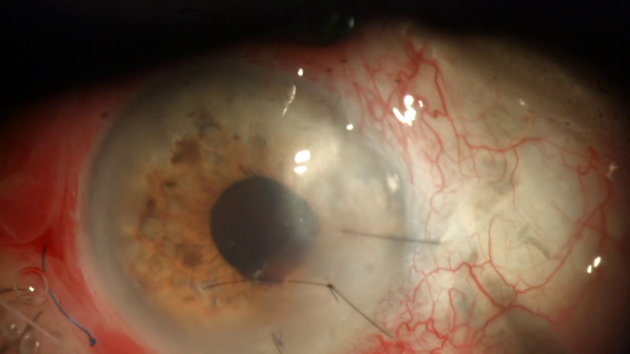 Aphakic eye + Yamane secondary IOL implantation with a variation - YouTube