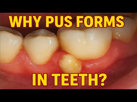 Why tooth have pus ||What is Pus in a TOOTH? - YouTube