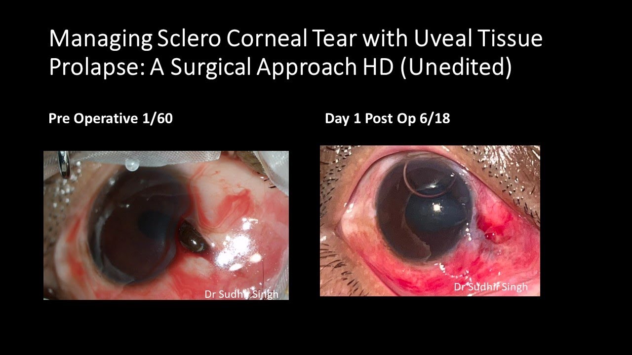 Managing Sclero Corneal Tear with Uveal Tissue Prolapse : A Surgical ...