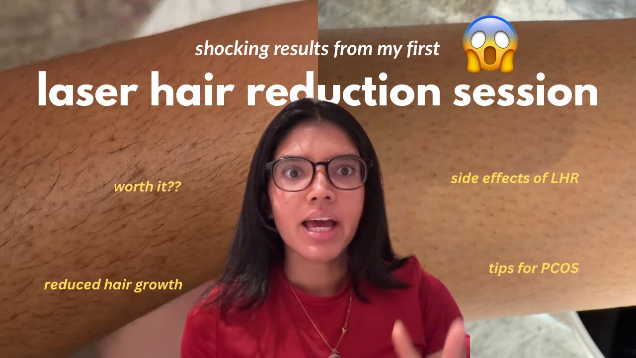 I Tried Laser Hair Reduction & Didn’t Expect THESE Results… - YouTube