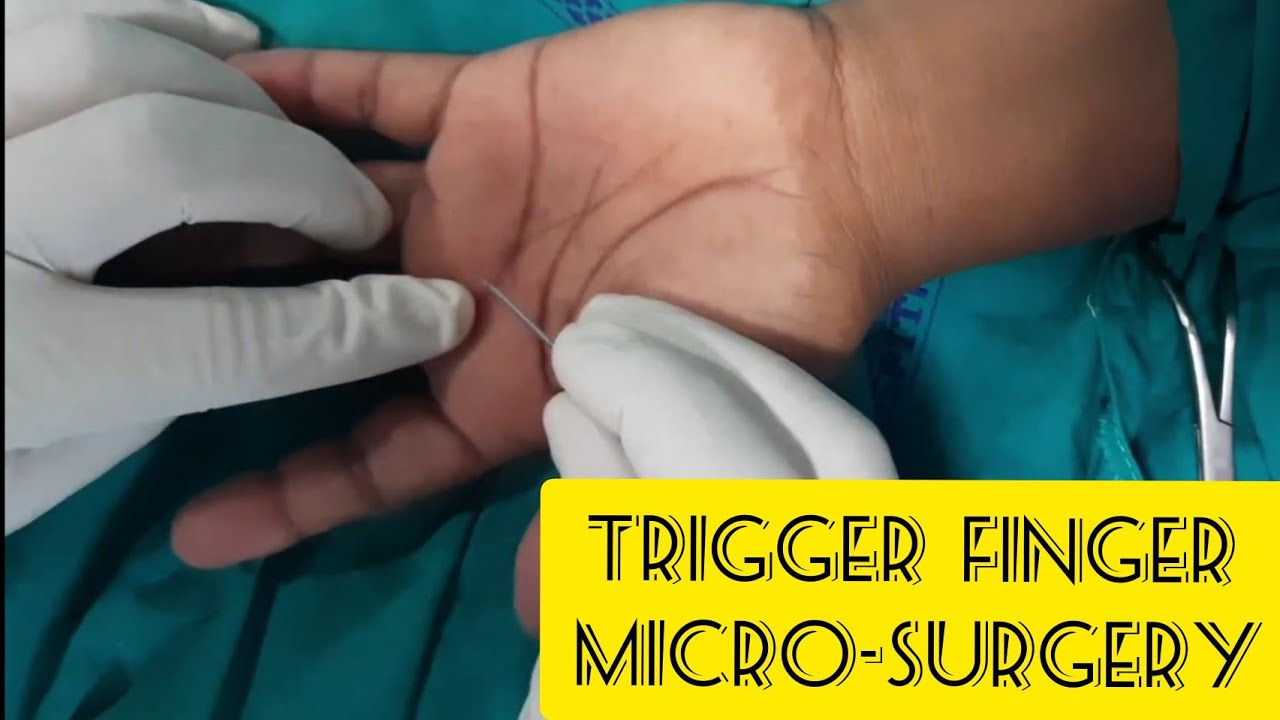 #triggerfinger Trigger finger Micro surgery/Percutaneous Trigger finger ...
