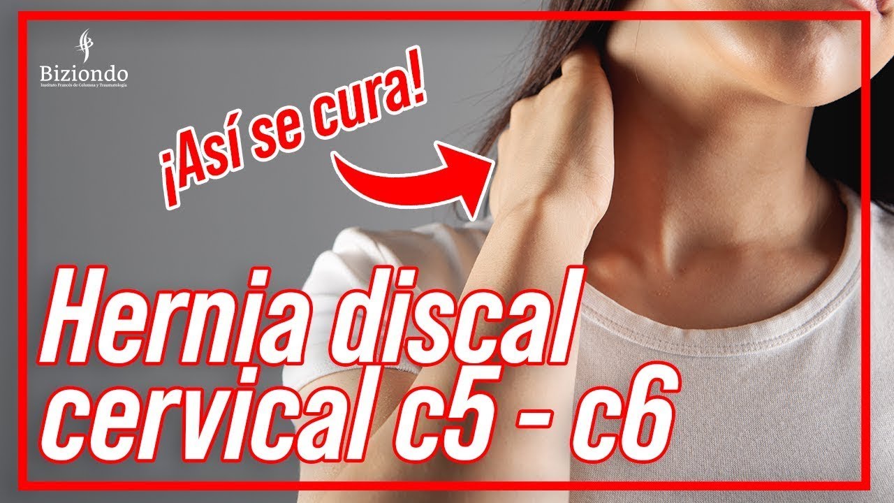 Tengo una HERNIA DISCAL CERVICAL en C5 - C6 😖 ︱ Biziondo - YouTube