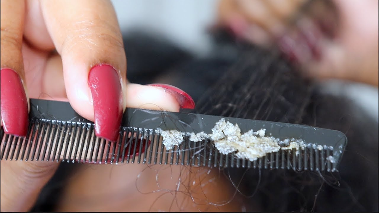 Dandruff Scratching | ASMR Dandruff Flakes - YouTube