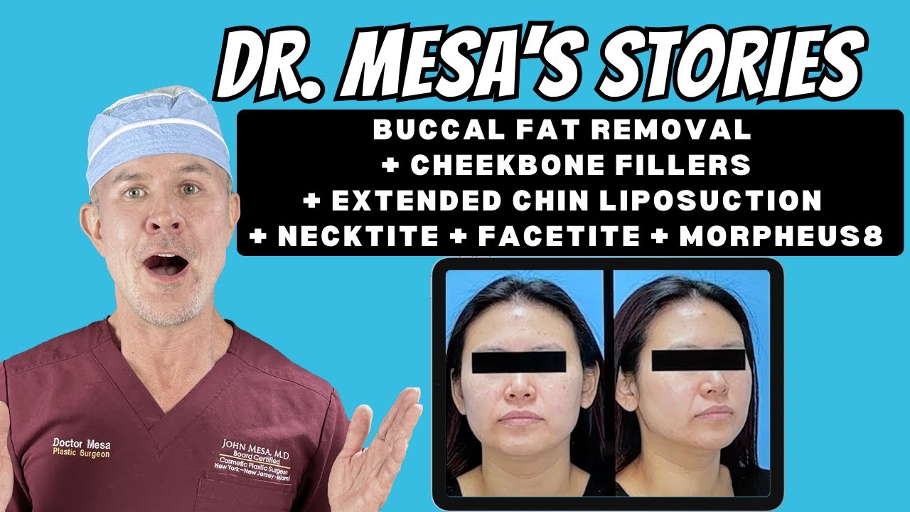 Dr. Mesa Story 128: Buccal Fat Removal + Cheekbone Fillers + Chin ...