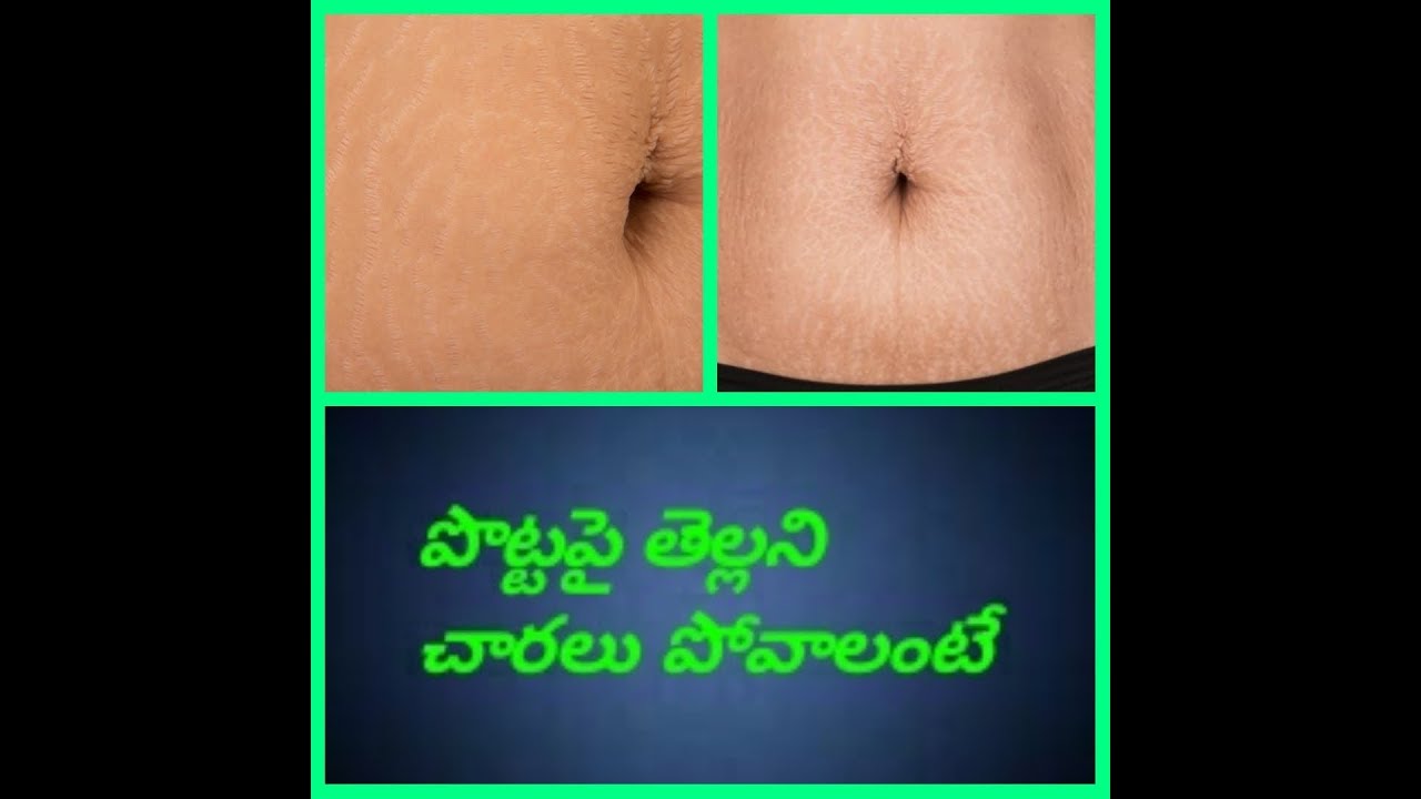 తెల్లని చారలు తగ్గాలంటే || Stretch Marks || Beauty Tips || Heath&Beauty ...