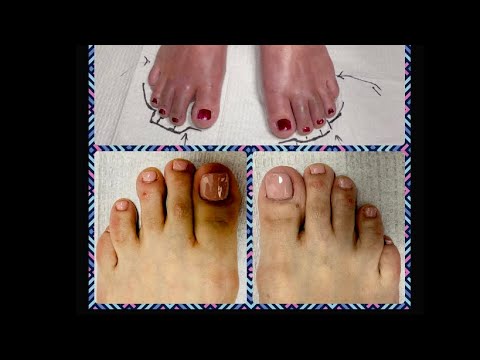 MINIMALLY INVASIVE SURGICAL FOOT TRANSFORMATION - YouTube