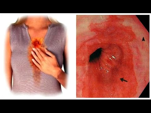 Saiba Sobre Refluxo Gastro-Esofágico e Remédios Caseiros Naturais ...