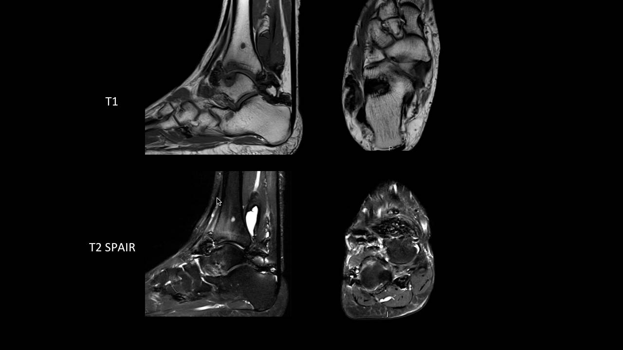 Sinovite Vilonodular Pigmentada Radiologia Brasileira Lesões Não