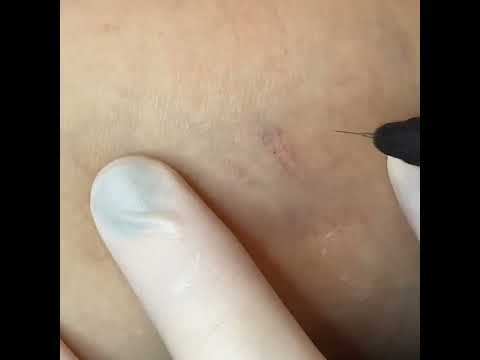 VeinGogh treatment - YouTube