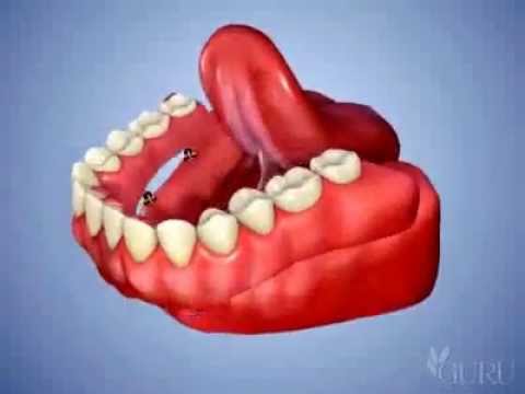 Austin Dental Implants - Blade Form Dental Implants - YouTube
