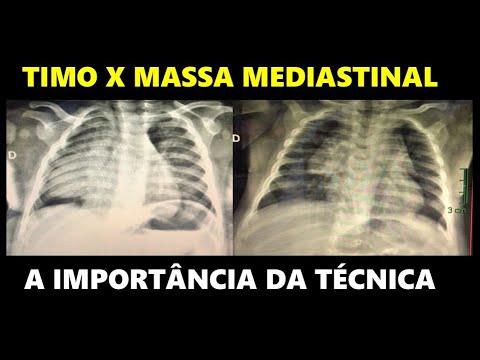 Timo no Rx de tórax | RX COMENTADO - YouTube