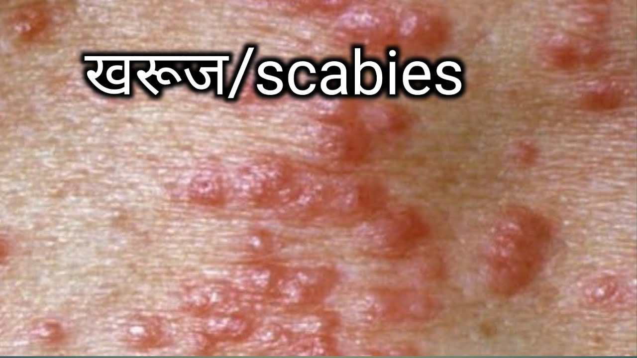 त्वचा रोग भाग ५ | खरूज घरगुती उपाय | खरूज लक्षणे | Kharuj Disease ...