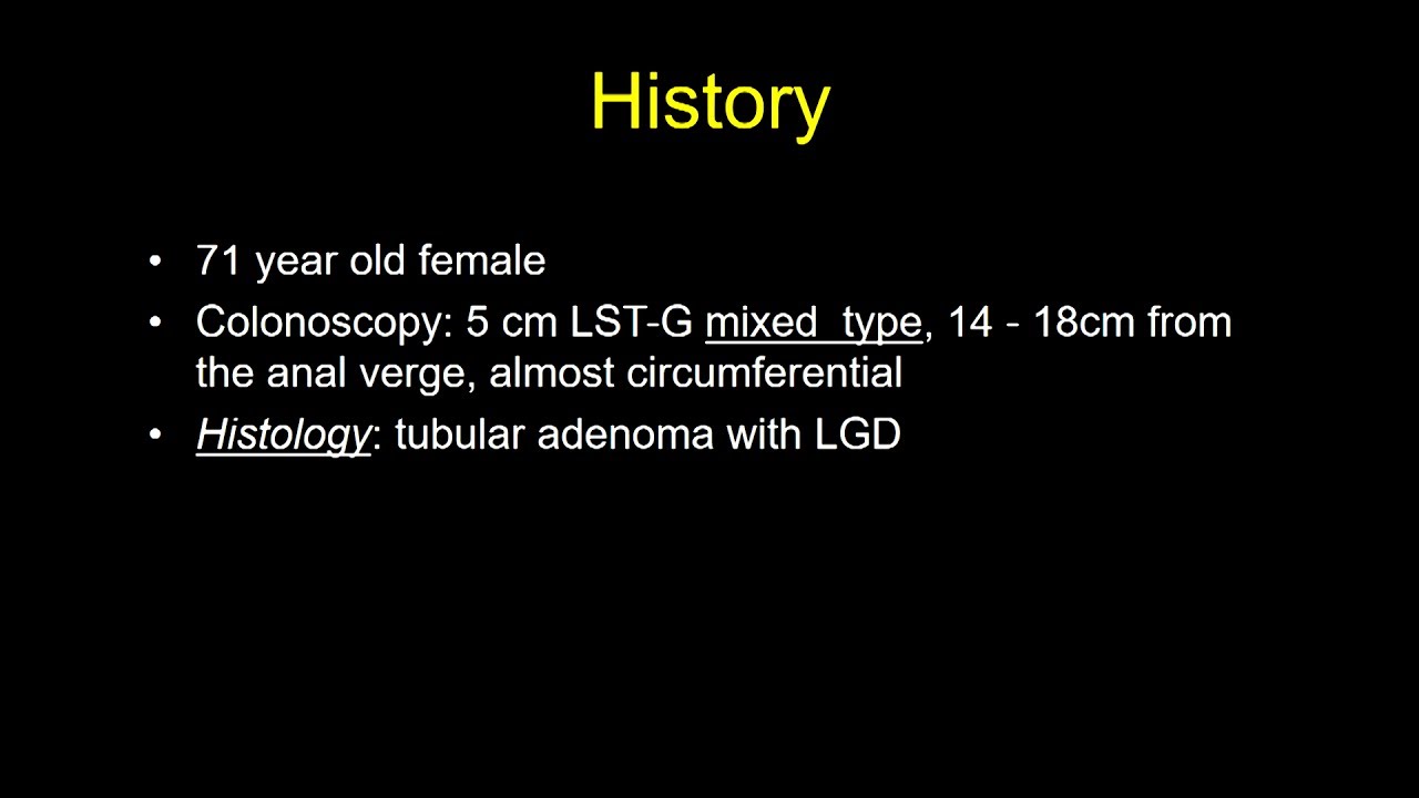 Endoscopic resection of a 5 cm circumferential LST-G mixed type in the ...