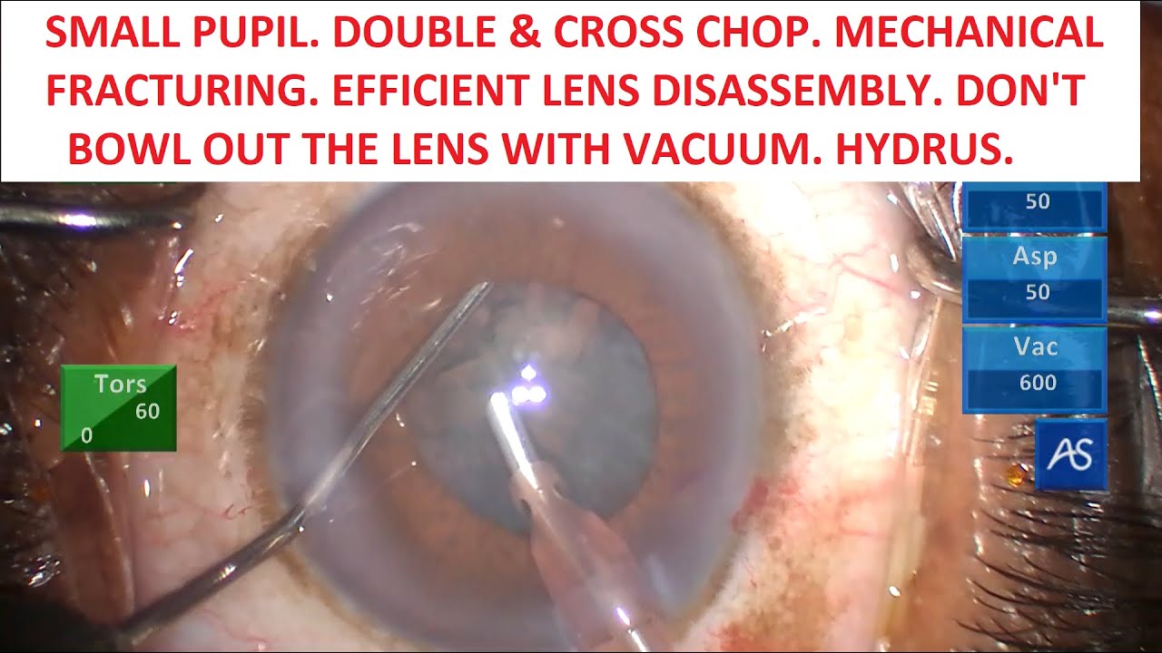 TBWTDCS #205: Small Pupil. Double & Cross Chop. Mechanical Fracture ...