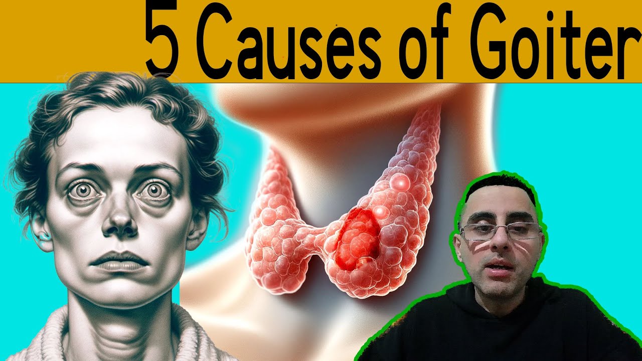 Top 5 Causes of Goiter - YouTube