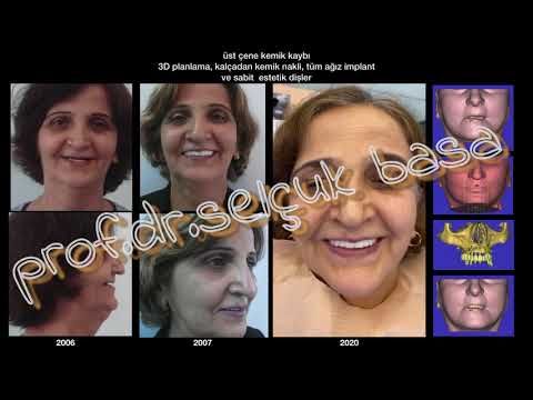 üst çenede ileri derecede kemik kaybı tedavisi ve 13 yıllık takip ✔️