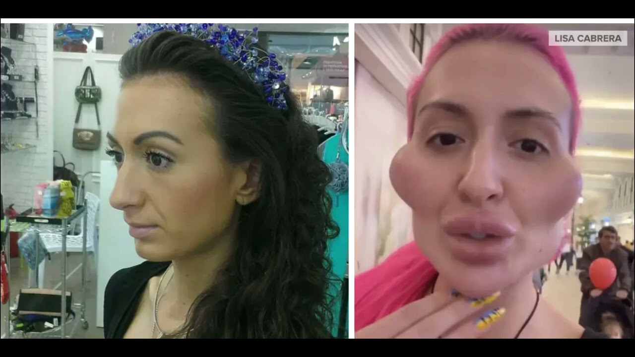Anastasia Pokreshchuk Has The World's Largest Cheeks - YouTube