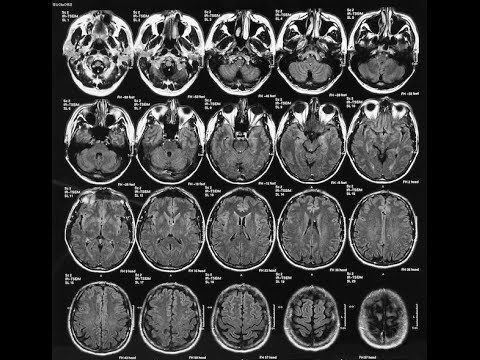 Trial #3- Functional MRI Parameters in SCD - YouTube