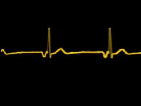 EKG Ritmo Nodal - YouTube