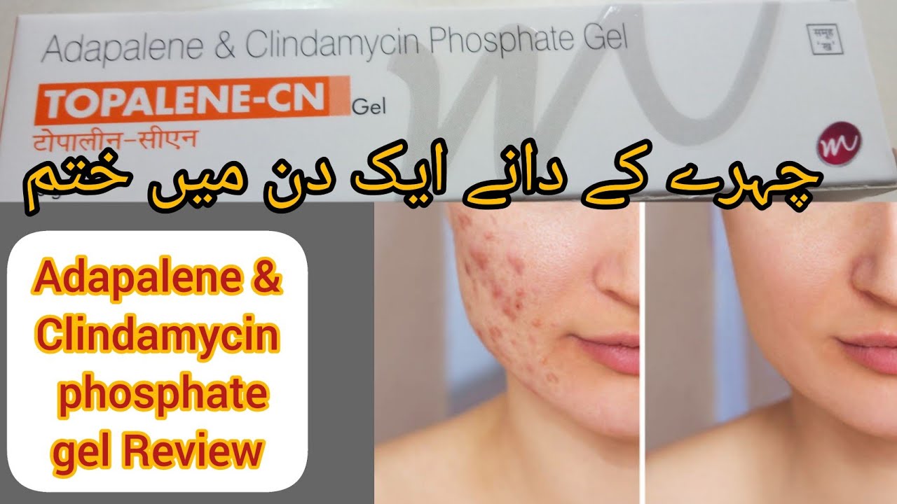 Topalene-cn Gel Review// Best Cream for Acne Pimple// Adapalene ...