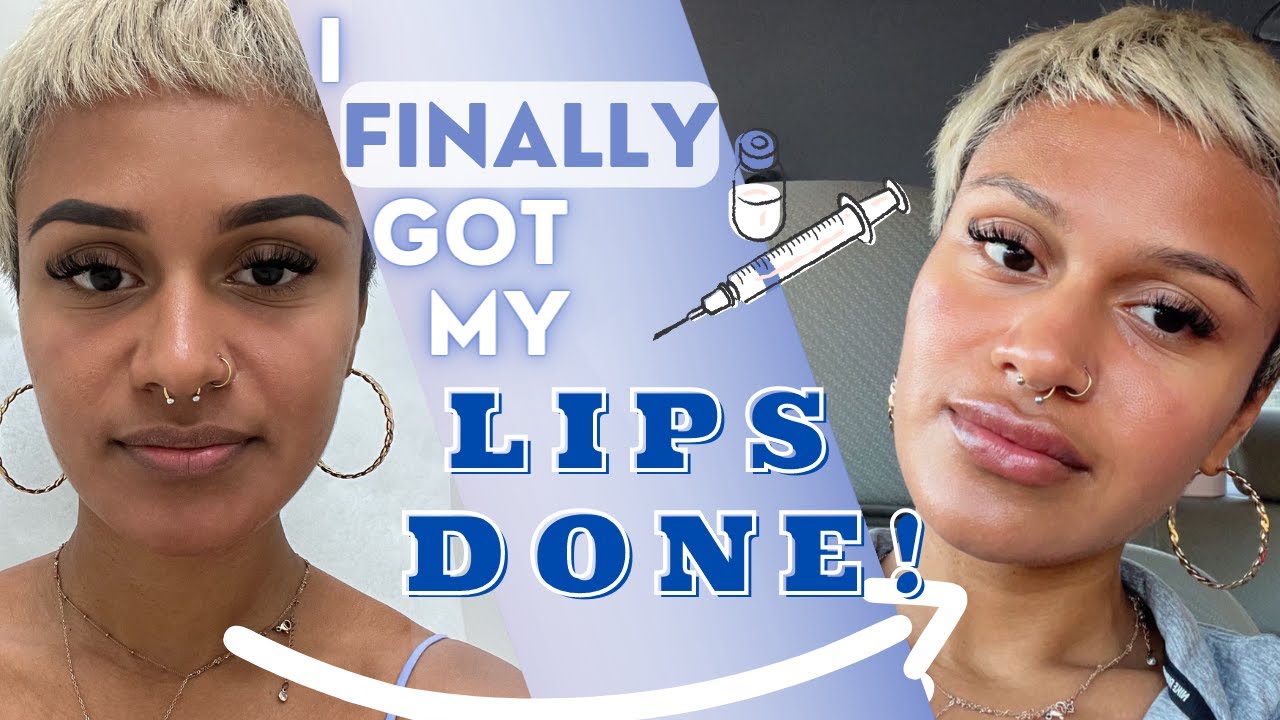 GETTING LIP FILLERS FOR THE FIRST TIME | MIAMI | VLOG 17 - YouTube