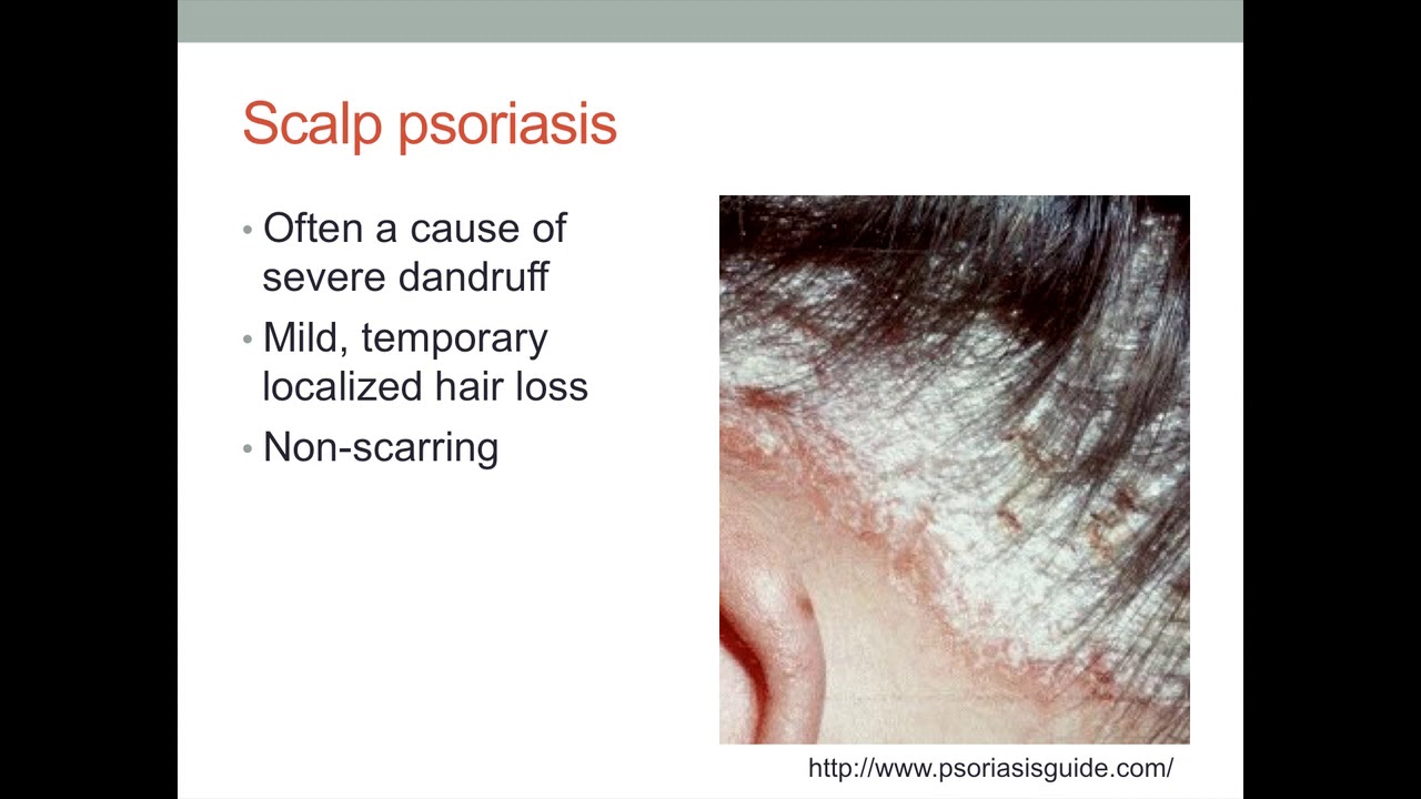 Dermatology - psoriasis - YouTube