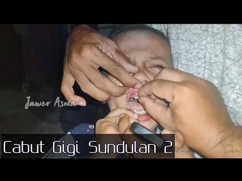 Gigi Sundulan 2 Bagian atas - YouTube