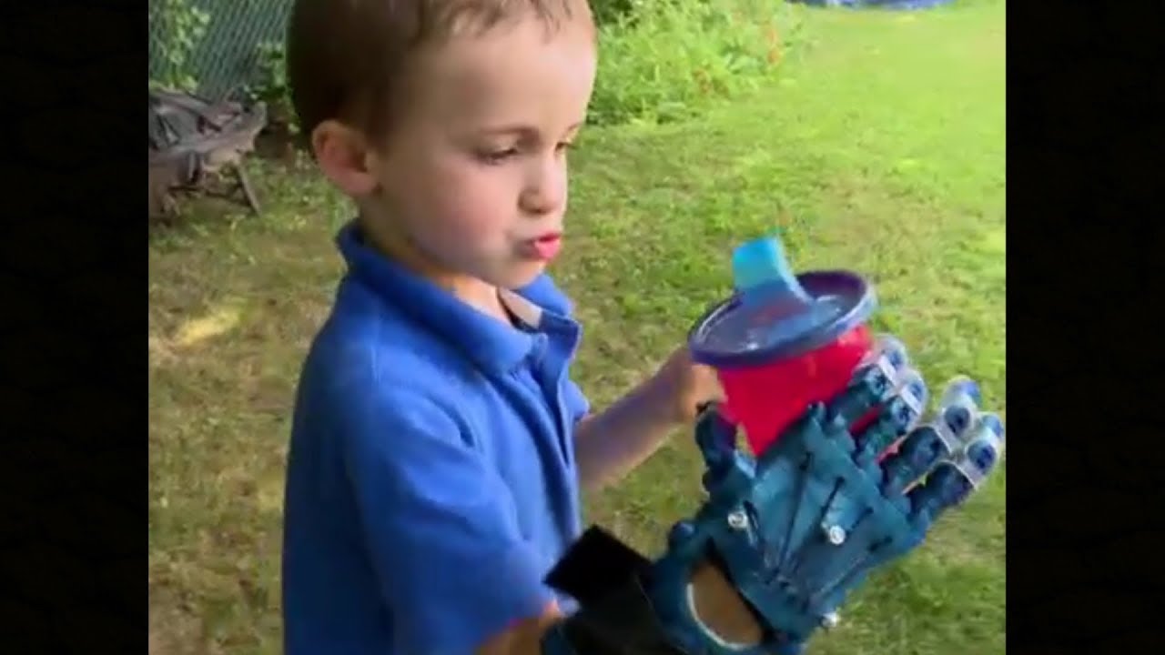 My Kid Is Half Robot And He Rocks It (Kids With Prosthetics Are ...