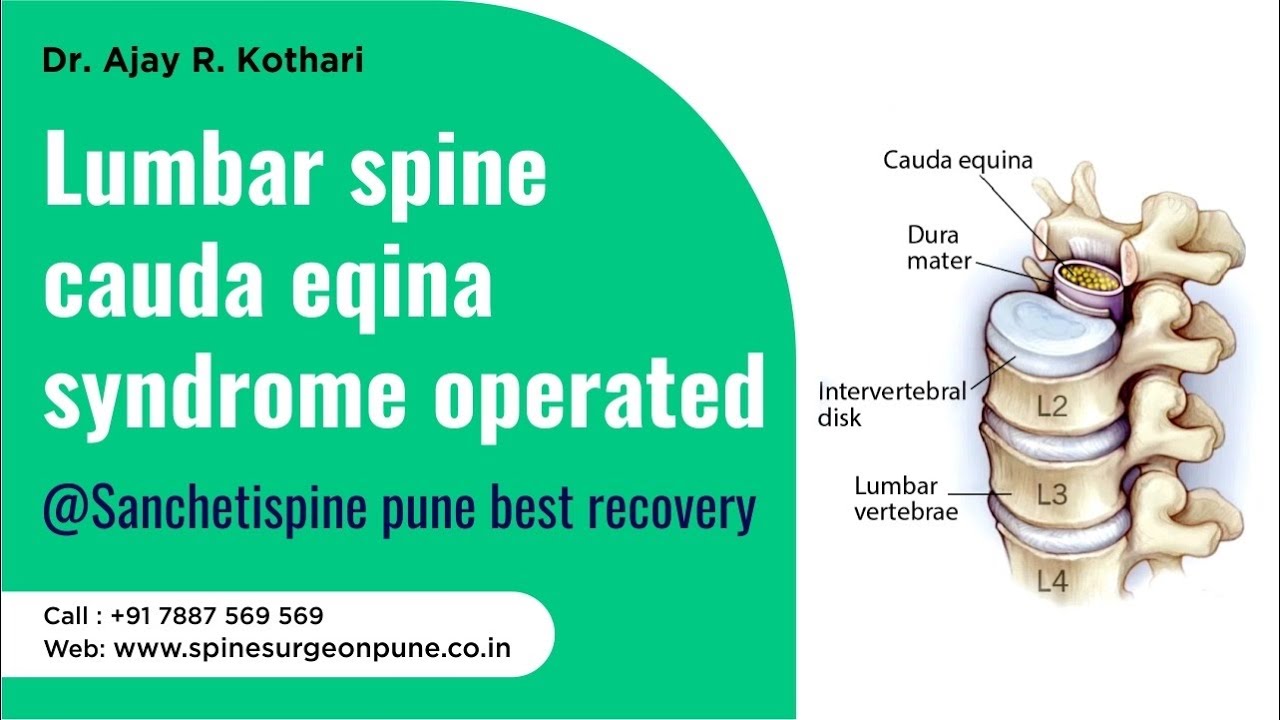 Lumbar spine cauda eqina syndrome operated @Sanchetispinepune best ...