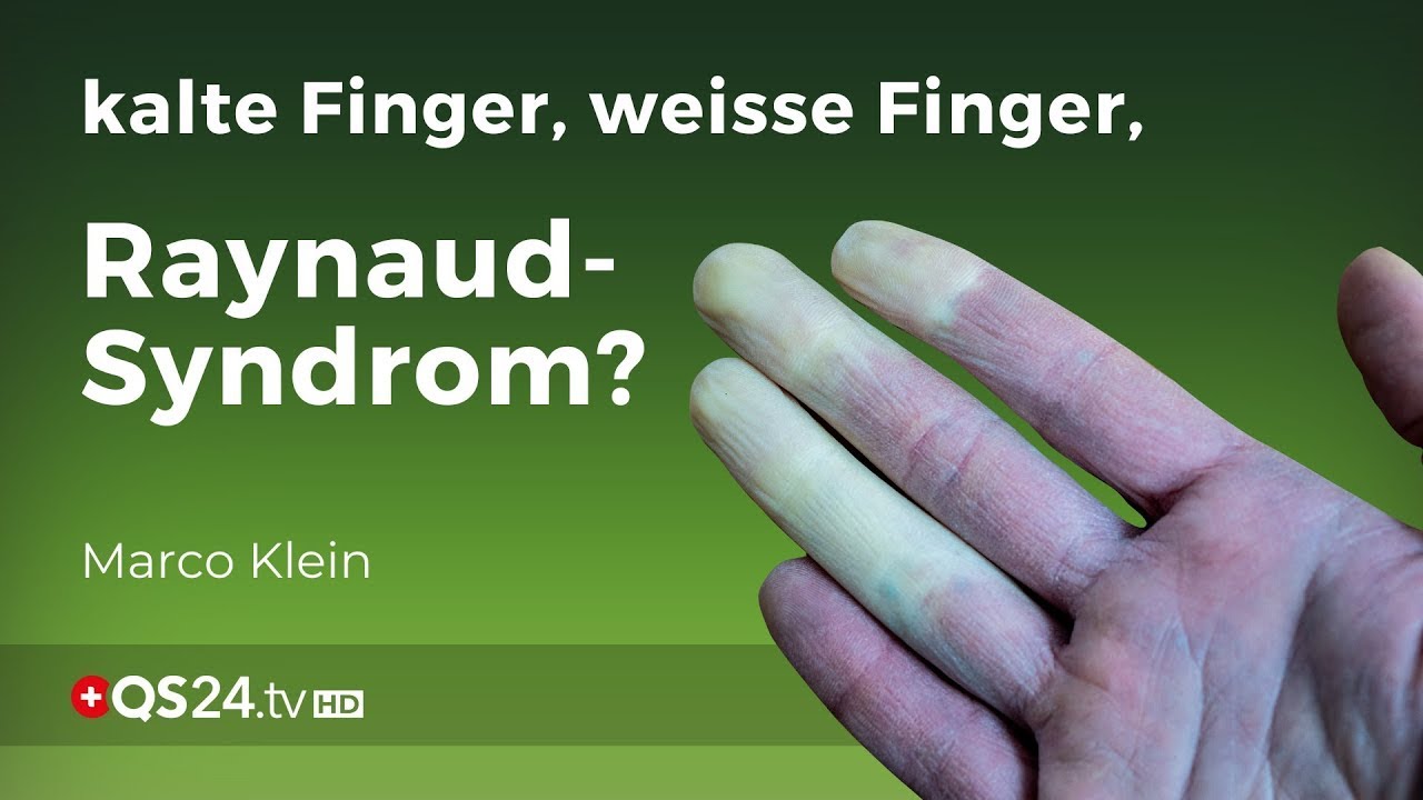 Raynaud-Syndrom: kalte Hände und Durchblutungsstörung | Kleinsche ...