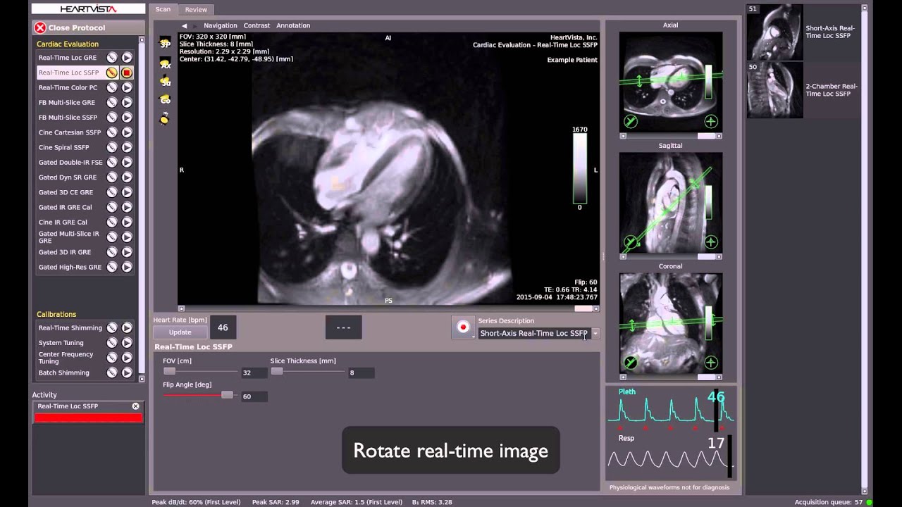 Running Real-Time Scans with the HeartVista Cardiac Package - YouTube