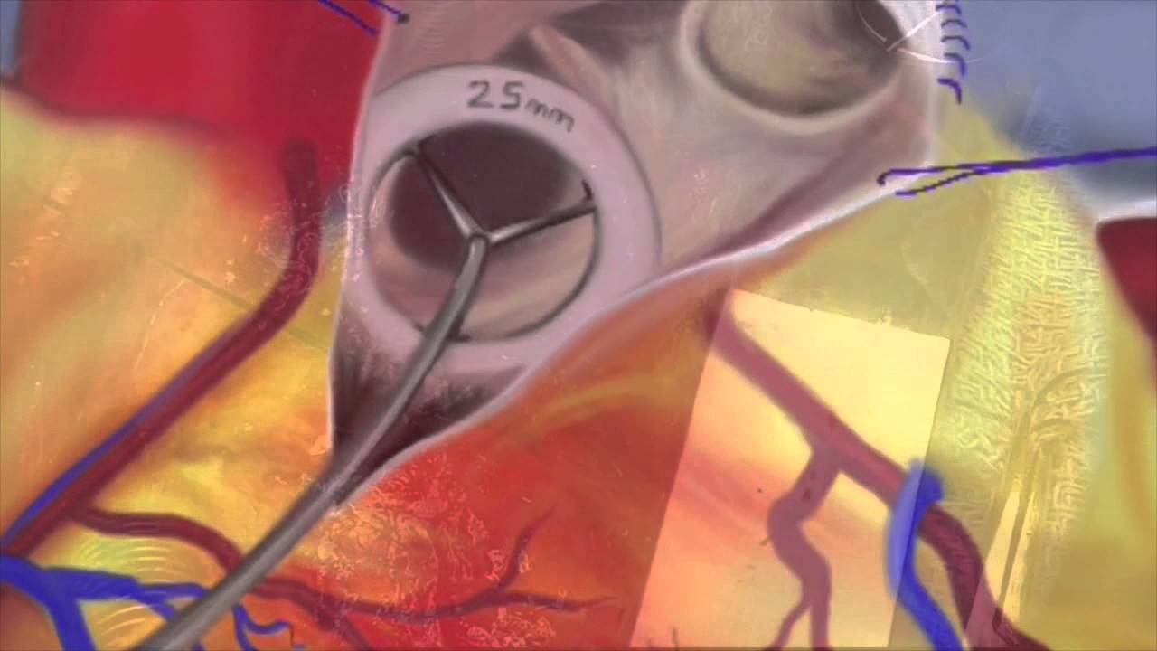 STS University Course 13: Adult Congenital Pulmonary Valve Replacement ...