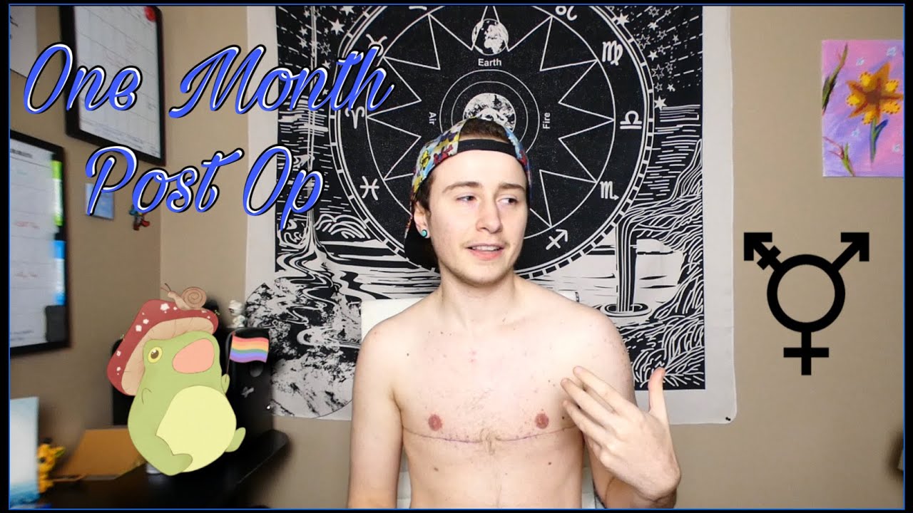 One Month Post Op Top Surgery With Dr Richard Bartlett FTM one-month-post-op-top-surgery-with-dr-richard-bartlett-ftm