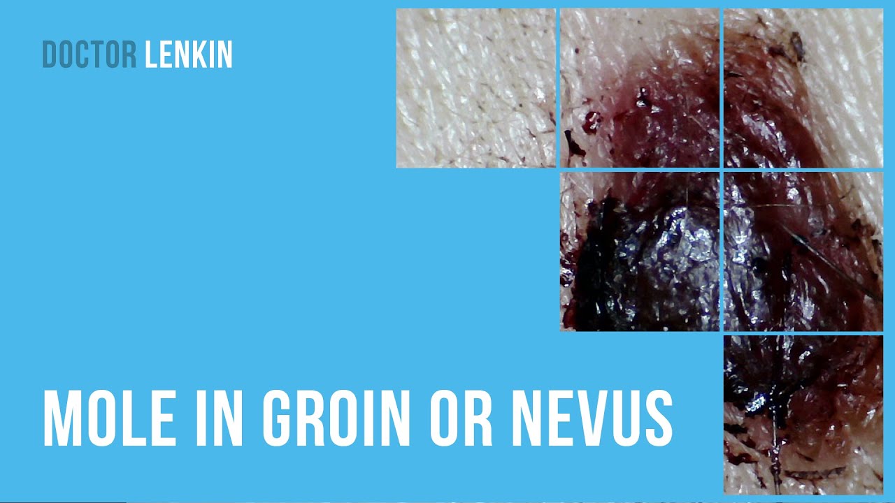 Mole in groin or nevus - YouTube