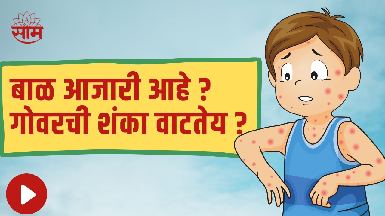 Measles Govar Disease : बाळाला ताप,सर्दी,खोकला आलाय ? गोवरचा संसर्ग तर ...